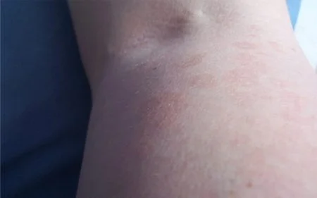 Urtikaria (Hives): Gejala-gejala, Punca dan Rawatan