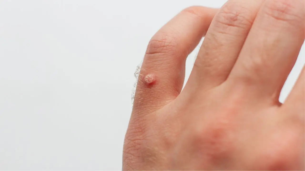 Cara Menghilangkan Ketuat di Kaki dan Anggota Badan