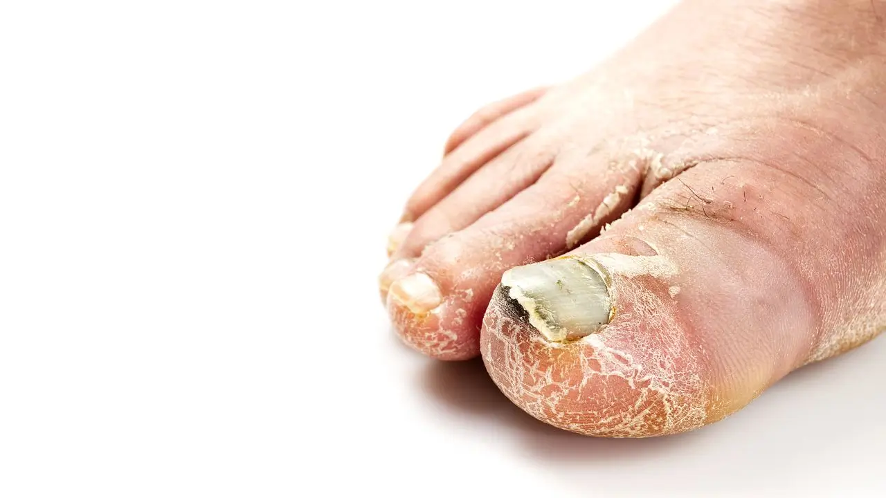 Apa itu Tinea Pedis? Apa yang Perlu Anda Tahu Tentang Kaki Atlet